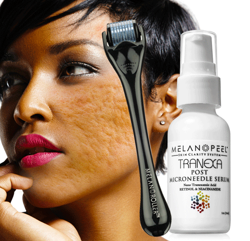 How To Safely Microneedle At Home - Aesthetic Skin & Anti-aging Authority