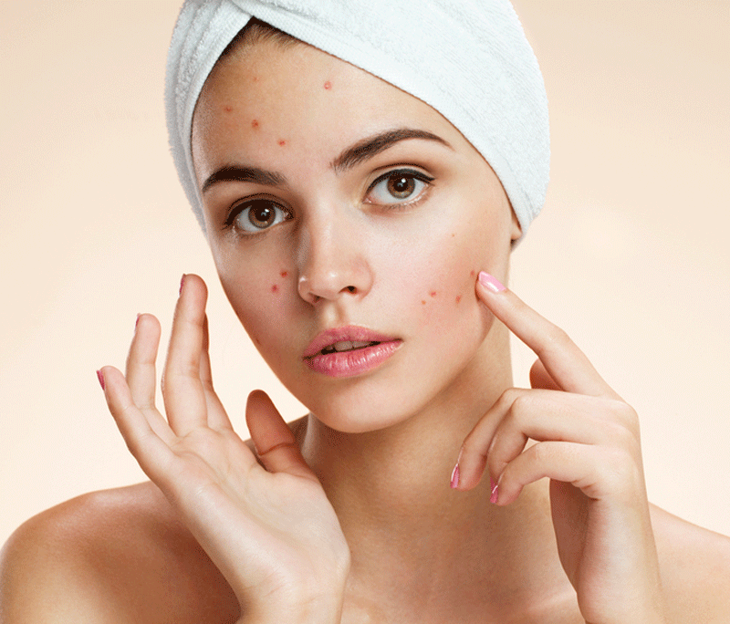 Teenage Acne - Aesthetic Skin & Anti-aging Authority